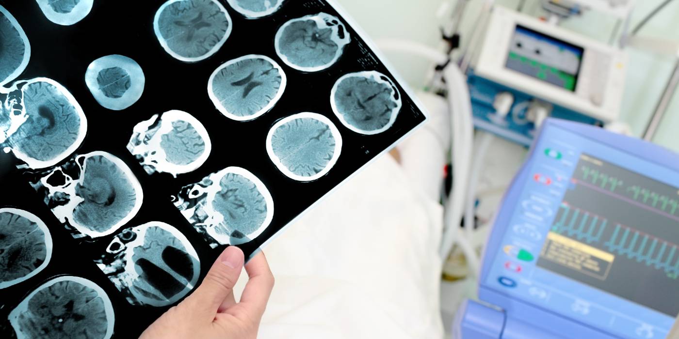 Study finds high prevalence of hidden brain changes in people with ...